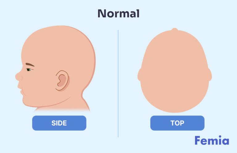 Baby's head shape: When to worry? - Femia Health