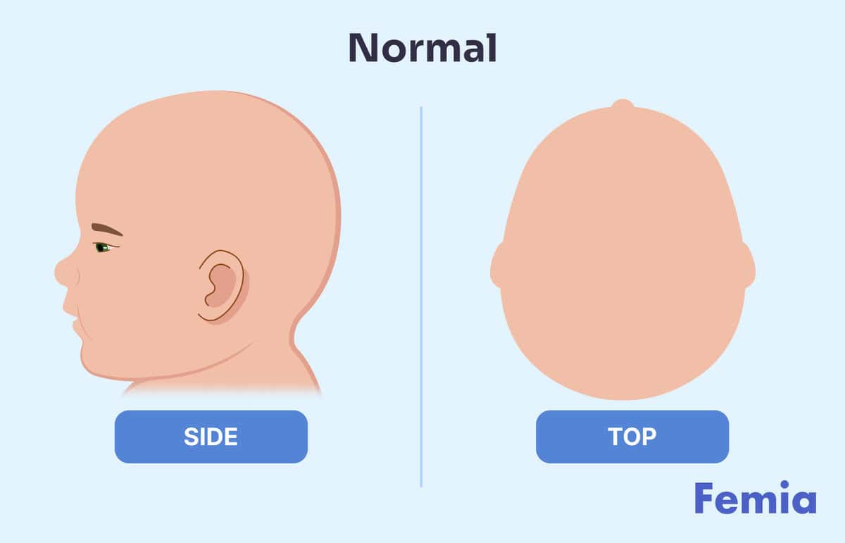 Baby's head shape: When to worry? - Femia Health