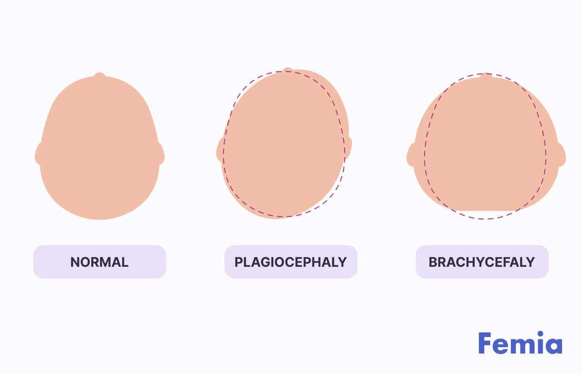 Baby's head shape: When to worry? - Femia Health