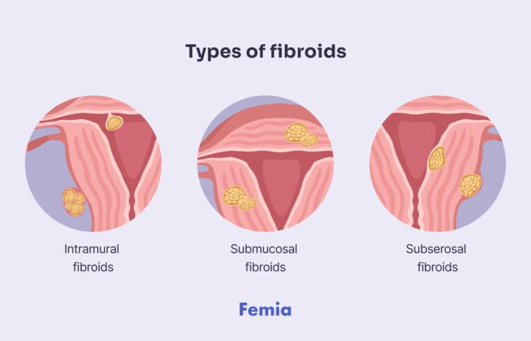 Fibroids And Pregnancy: Symptoms, Risks, And Tips For A Healthy ...